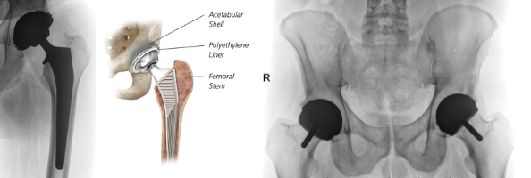 Totale heupprothese | AZ Klina